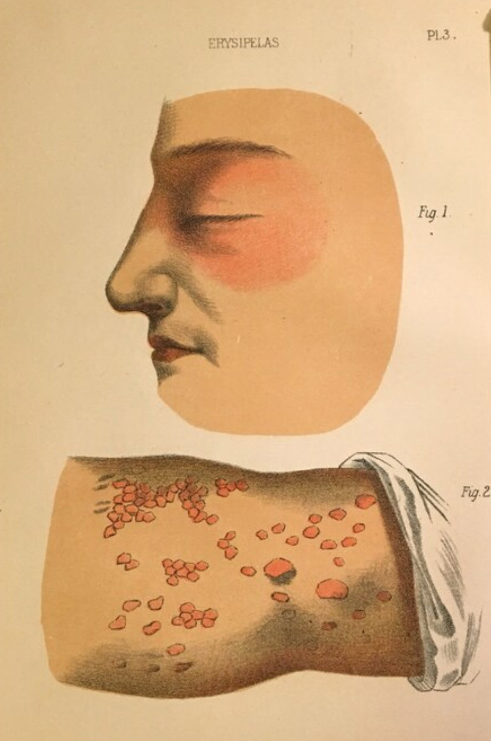 About Erysipelas – Truby Farmhouse Apollo PA